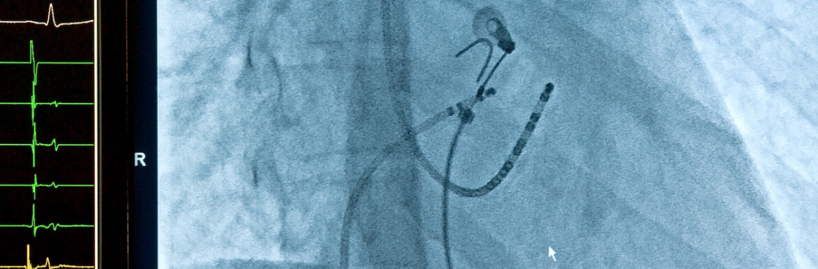 Ablatie cardiaca | Tratamentul eficient al aritmiilor