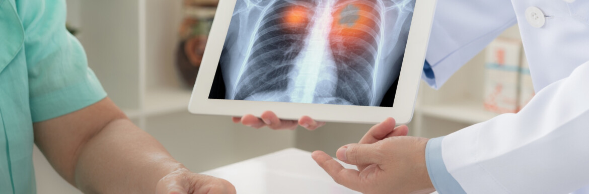 Ce este un abces pulmonar? Află mai multe de la SANADOR!