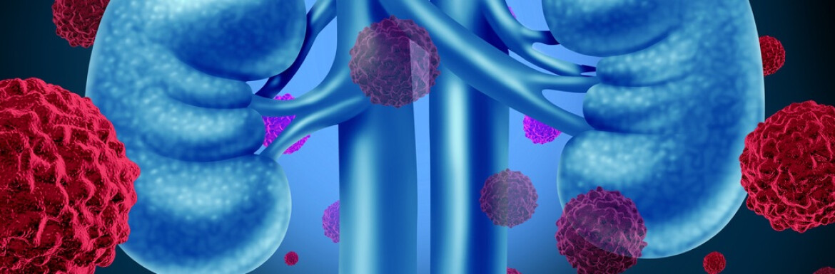 Calcul renal coraliform | Urologie | SANADOR