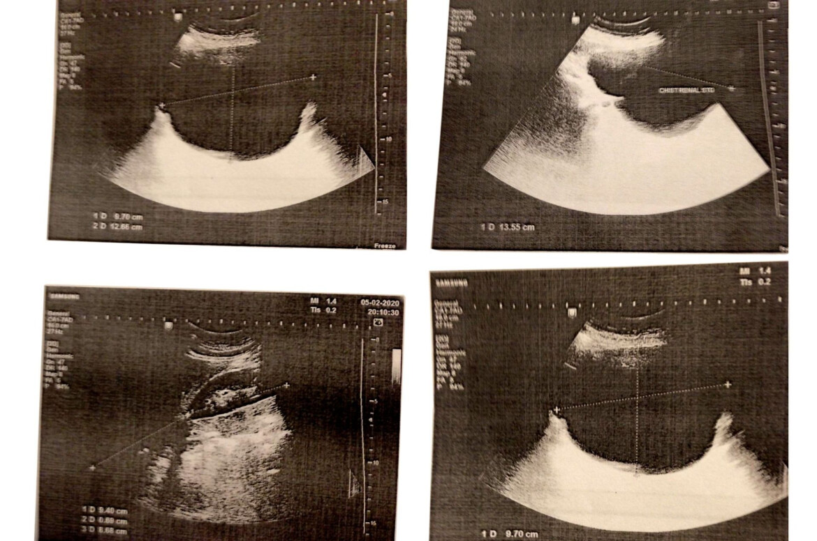 Chist renal și sindrom de joncțiune pielo-ureterală | SANADOR