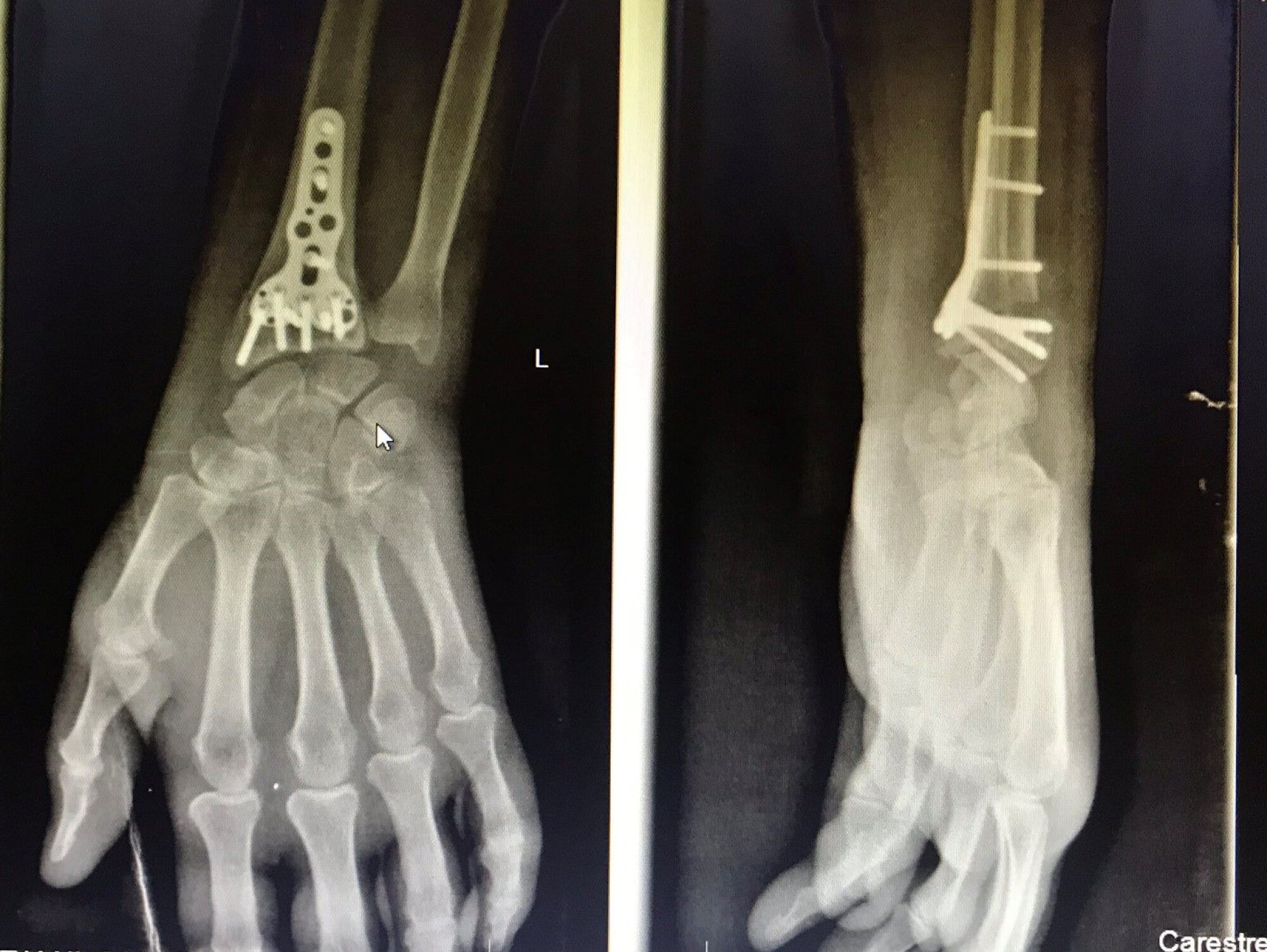 Fracturile pumnului | SANADOR