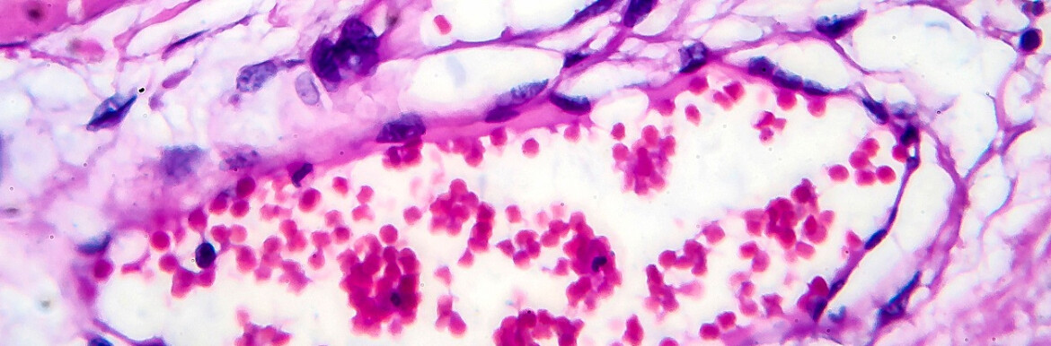 Limfom Hodgkin | Cancerul sistemului limfatic | SANADOR