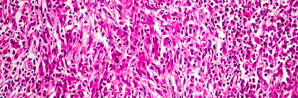 Limfom non-Hodgkin | Ce este și cum îl putem recunoaște?